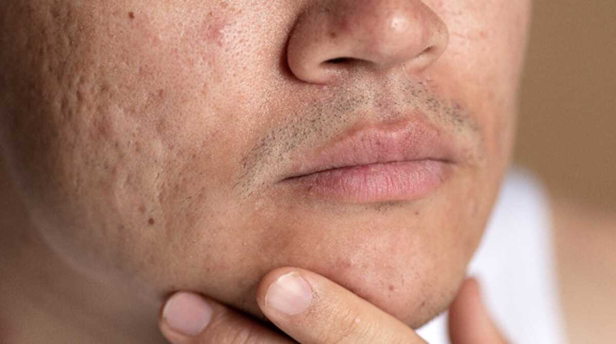 Cicatrizes: o que são e como lidar com elas? Dermatologista explica ...